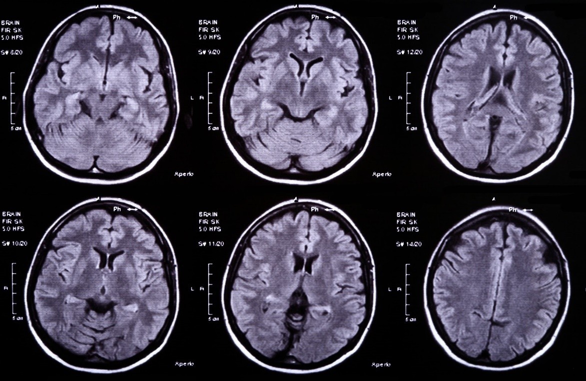 Common Types of Brain Injuries Diagnosed in New York City